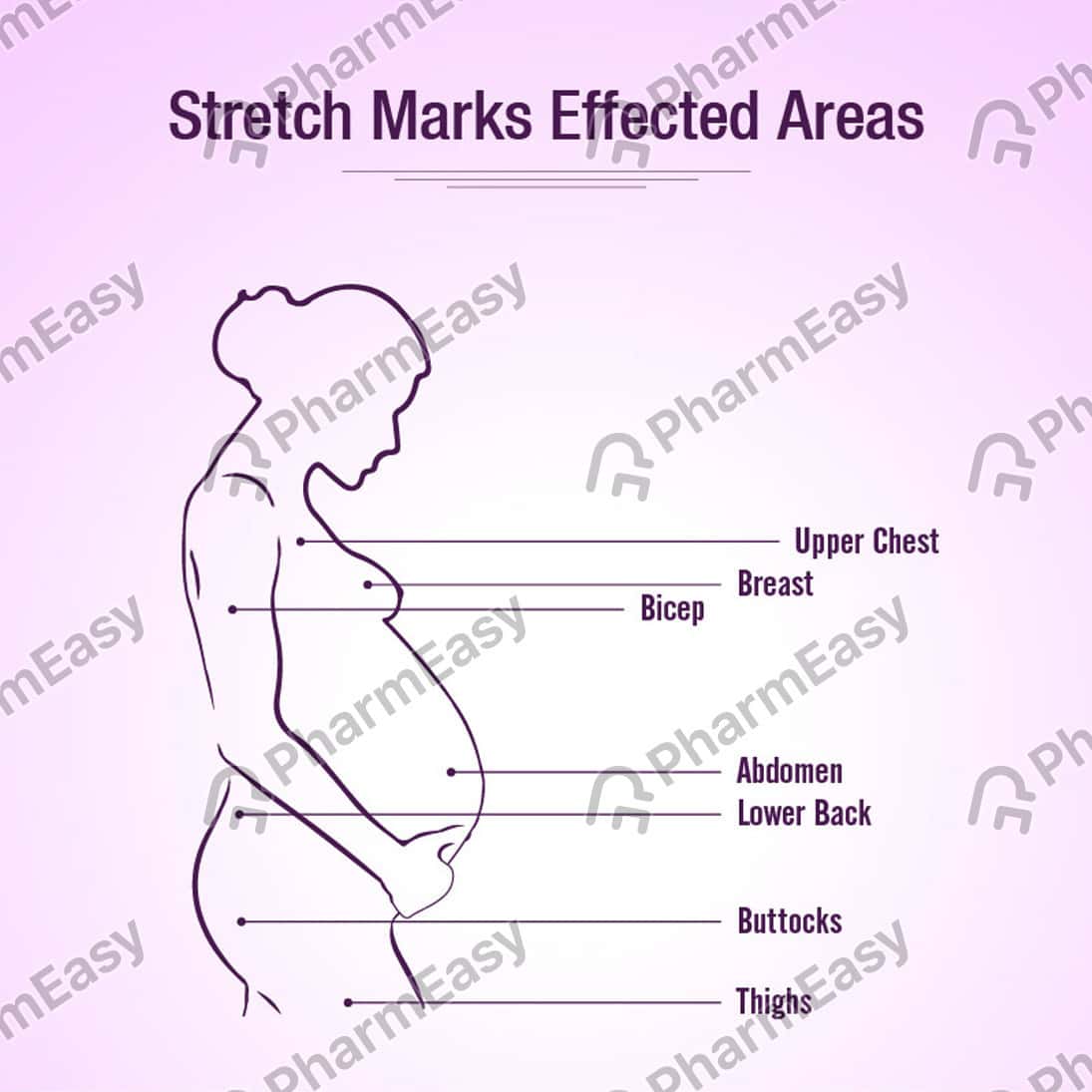 Buy MEDERMA STRETCH MARKS THERAPY TUBE OF 25GM CREAM Online & Get Upto ...