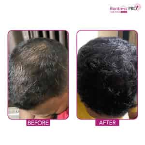 Buy BONTRESS PRO PLUS SCALP TETRAPEPTIDES | SERUM | 60 ML Online & Get ...