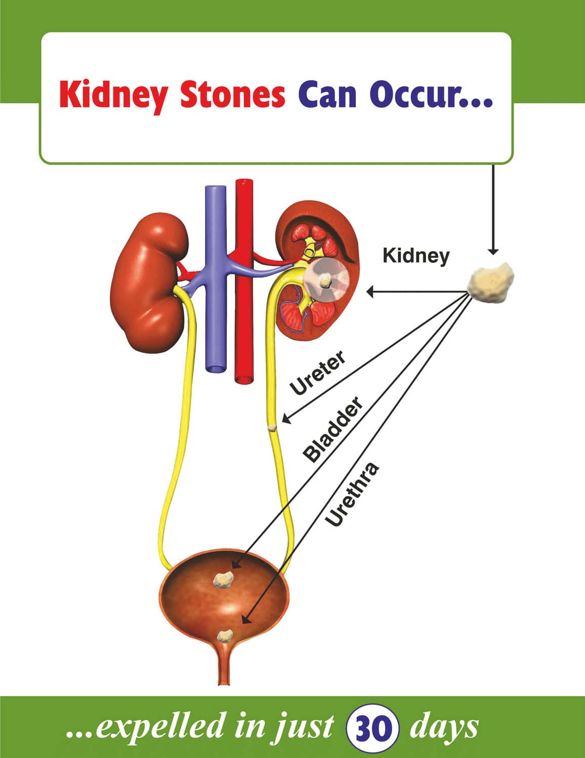Buy STONEX CAPSULE SINGLE SOLUTION FOR STONES - 10 X 10 Online & Get ...