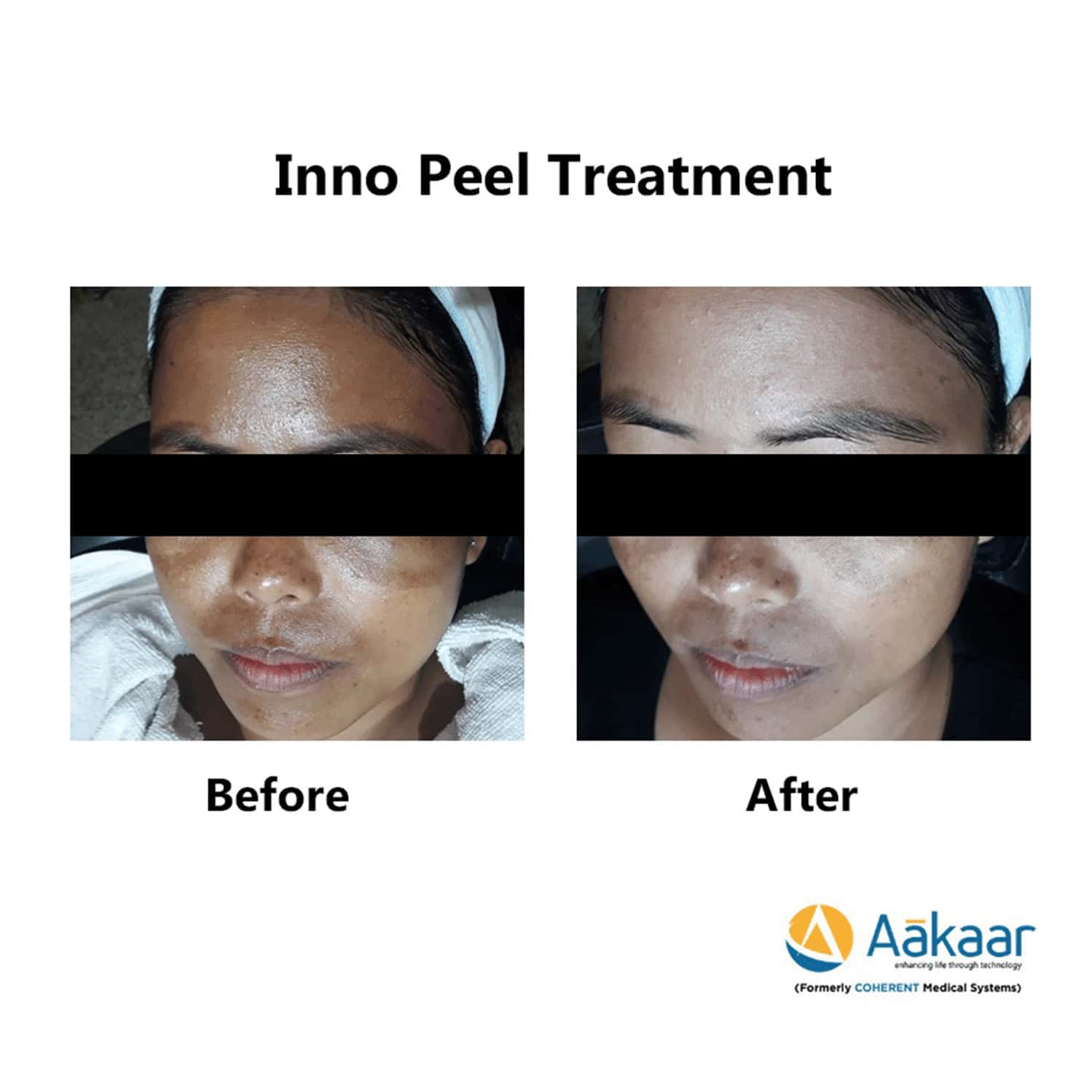 Buy BILUMA CREAM Online & Get Upto 60% OFF at PharmEasy